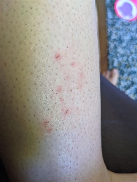 Bug Bite Identification R Bugbites