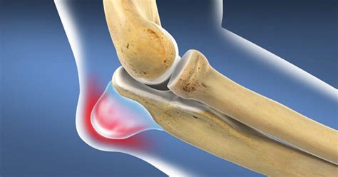 Bone Spur On Elbow Treatment Elbow Bone Spurs Causes Symptoms And Treatment Options