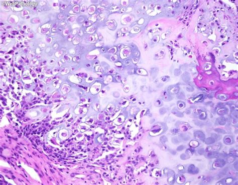 Chondroblastic Osteosarcoma