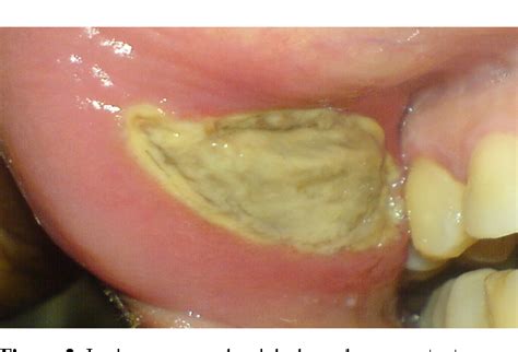 Necrotizing Stomatitis