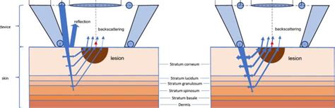 Classification Of Melanocytic Lesions Using Direct Illumination