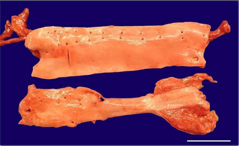 Gross View Of The Aorta Completely Free Of Atherosclerotic Lesions Download Scientific Diagram