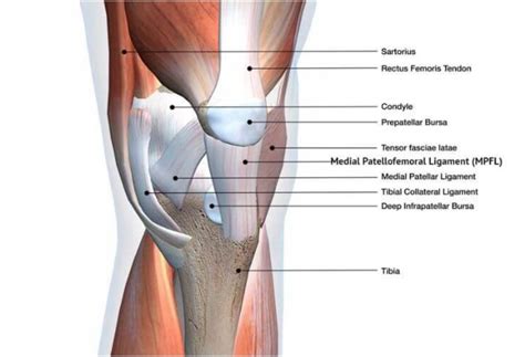Medial Patellofemoral Ligament Mpfl Reconstruction Surgery Midwest Orthopaedics