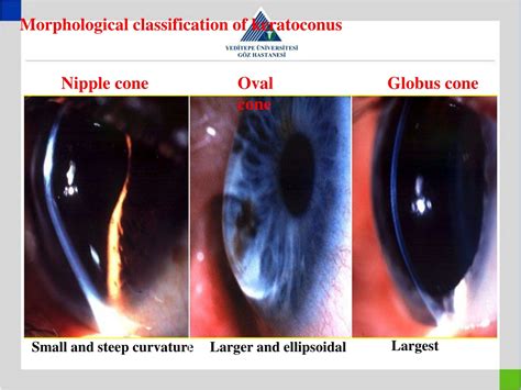 Ppt Disorders Of The Conjunctiva And Cornea Powerpoint Presentation