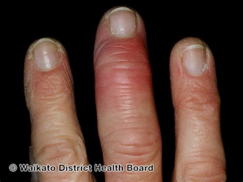 Erysipeloid Wikiprojectmed