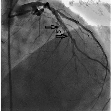 Right Coronary Angiogram Showing The Dissection In The Right Coronary