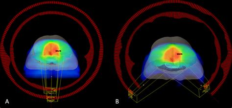 Treatment Planning Design For Two Techniques A F Vmat B P Vmat