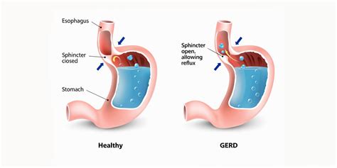 Esophageal Manometry And 24 Hour Ph Impedance Key Strategies For Gerd