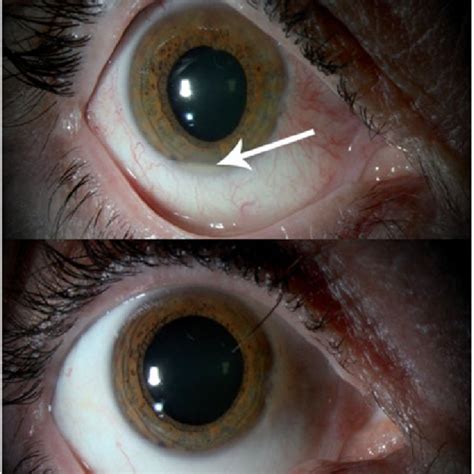 Pdf Hypopyon Uveitis Following Panretinal Photocoagulation In A