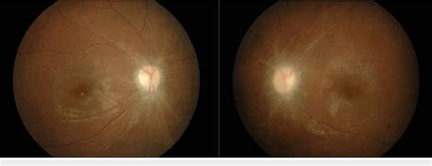 Bilateral Optic Disc Atrophy With Attenuated Arteriolar And Dilated