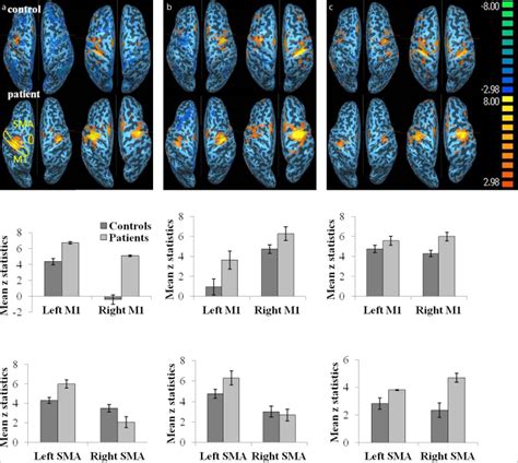 Abnormal Subcortical Activity In Congenital Mirror Movement Disorder