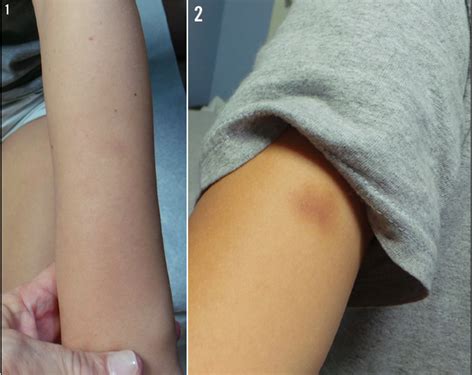 Telltale Petechiae And Bruises Abusive Strangulation Of An Adolescent