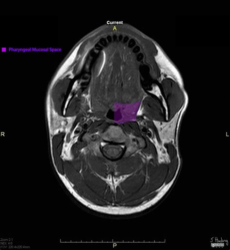 Lateral Pharyngeal Space Abscess