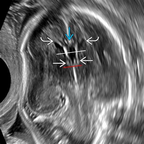 Absent Cavum Septi Pellucidi Radiology Key