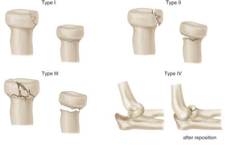 Fractura De Codo Cabeza De Radio Qué Es Causas Síntomas
