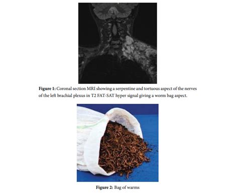 Plexiform Neurofibroma Mri