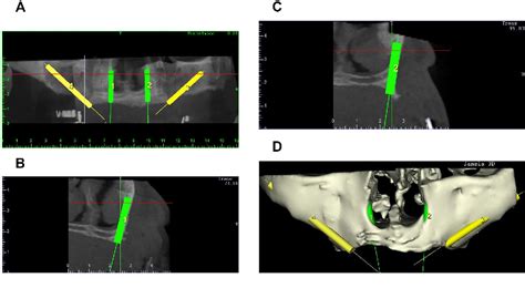 Figure 1 From Extra Long Transnasal Implants As Alternative For Quad Zygoma Case Report