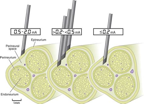 The Role Of Nerve Localization Techniques In Safety Anesthesia Key