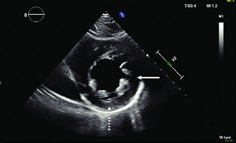 Transthoracic Echocardiogram In The Short Axis View Myocardial Crypts