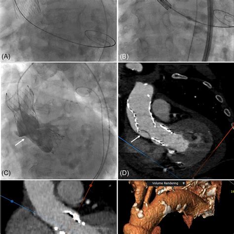 Permanent Pacemaker Indications Percentages Ppi Permanent Pacemaker