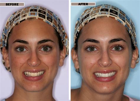 Zoom Whitening Before And After