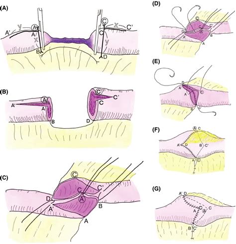 Surgical Technique For Sasaki‐w Anastomosis Schema A Measurement Download Scientific