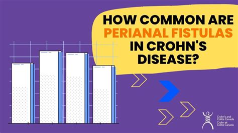 How Common Are Perianal Fistulas In Crohns Disease Youtube