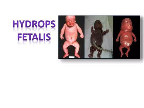 Hydrops 20fetalis Pptx