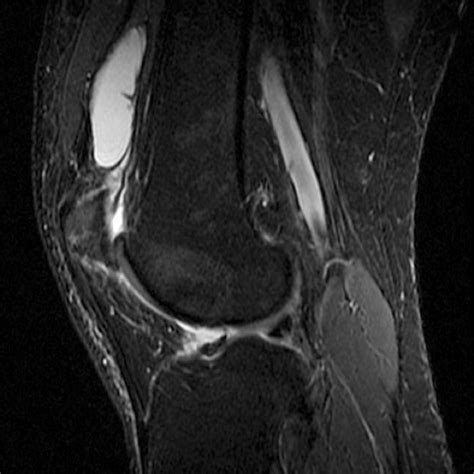 Synovial Plicae Of The Knee Radsource