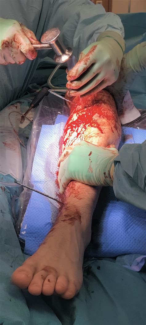 Bone Extension Surgery To Treat Fibular Hemimilia Rmedicalgore