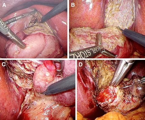 Surgical Procedure In Patients With Severe Cholecystitis A Gallbladder