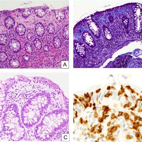 Segmental Colitis Associated With Diverticular Disease A In This Download Scientific Diagram