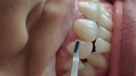 Cuspid Teeth Removal At Santos Long Blog