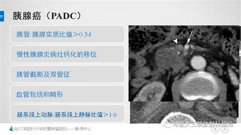 慢性胰腺炎与胰腺癌的影像学鉴别诊断思路文章