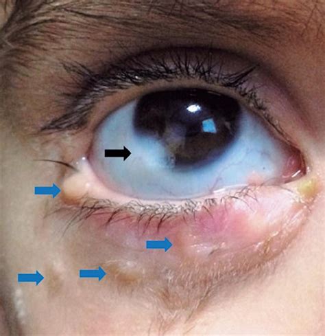 Scielo Brasil Atypical Presentation Of Fibroepithelial Polyp A