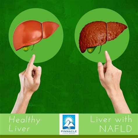 Healthy Liver Vs Unhealthy Liver At Alex Wright Blog
