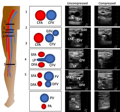 Lower Extremity Dvt Toronto Internal Medicine Pocus