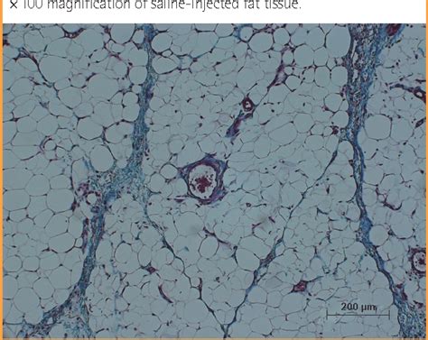 Figure 1 From The Effect Of Phosphatidylcholine And Deoxycholate Compound Injections To The