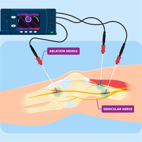 Knee Ablation Recovery Time Cryoablation Cryotherapy Cryosurgery