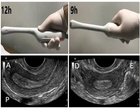 Ultrassom Transvaginal Cancer De Ovario Quais Os Sintomas De Câncer