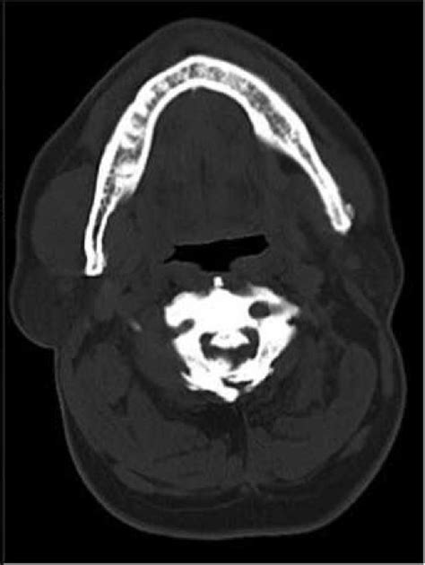 Recent Ct Scan Cervical Spine Reveals Post Op Defect Of Laminectomy Download Scientific
