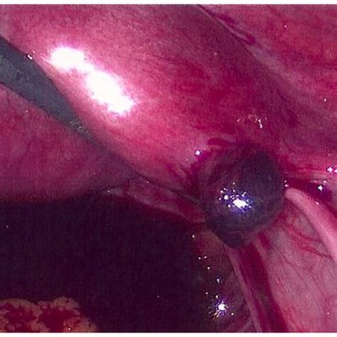Left Interstitial Pregnancy After Ipsilateral Salpingectomy Case 3