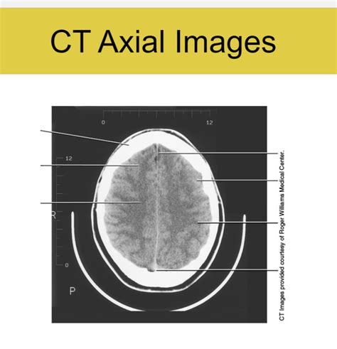 Ct Axial Image 1 Diagram Quizlet