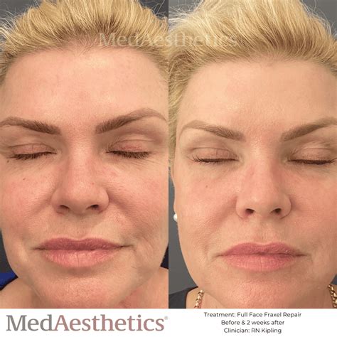 Laser Skin Treatment Perth Fraxel Laser Perth