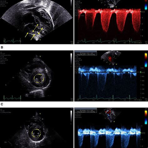 Representative Images From Echocardiograms Obtained During The