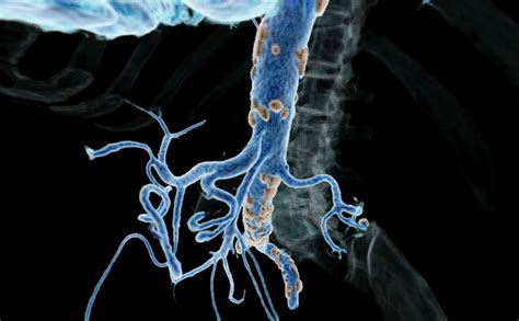 Ct Body Advanced Visualization Package Terarecon