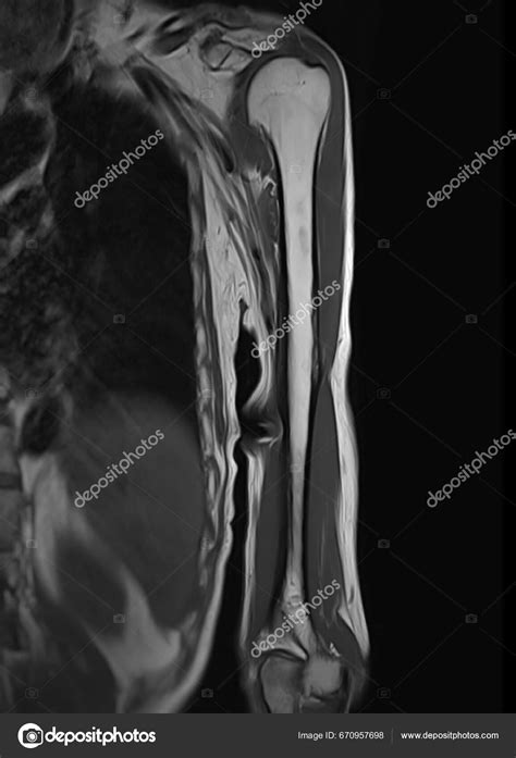 Mri Tulang Humerus Kiri Untuk Diagnosis Tumor Tulang — Foto Stok © Samunella 670957698