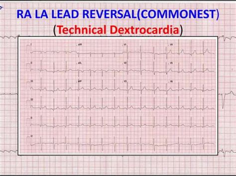 Artifacts In Ecgpptx