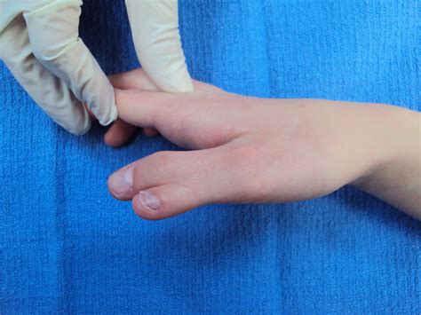 30 Facts About Duplication Of The Thumb Unilateral Biphalangeal