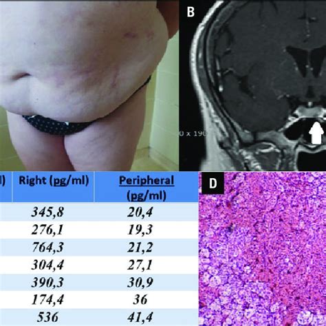 A Cushingoid Features In A 32 Year Old Female Postpartum B